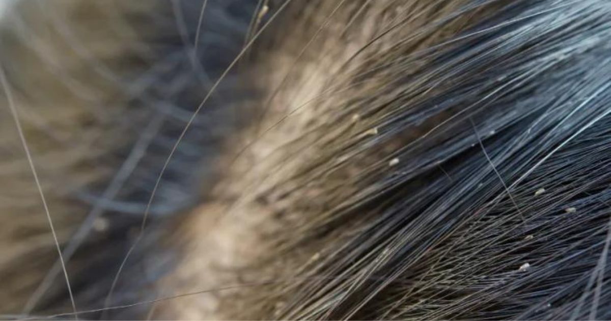 Lice Archives | The Lice Clinics